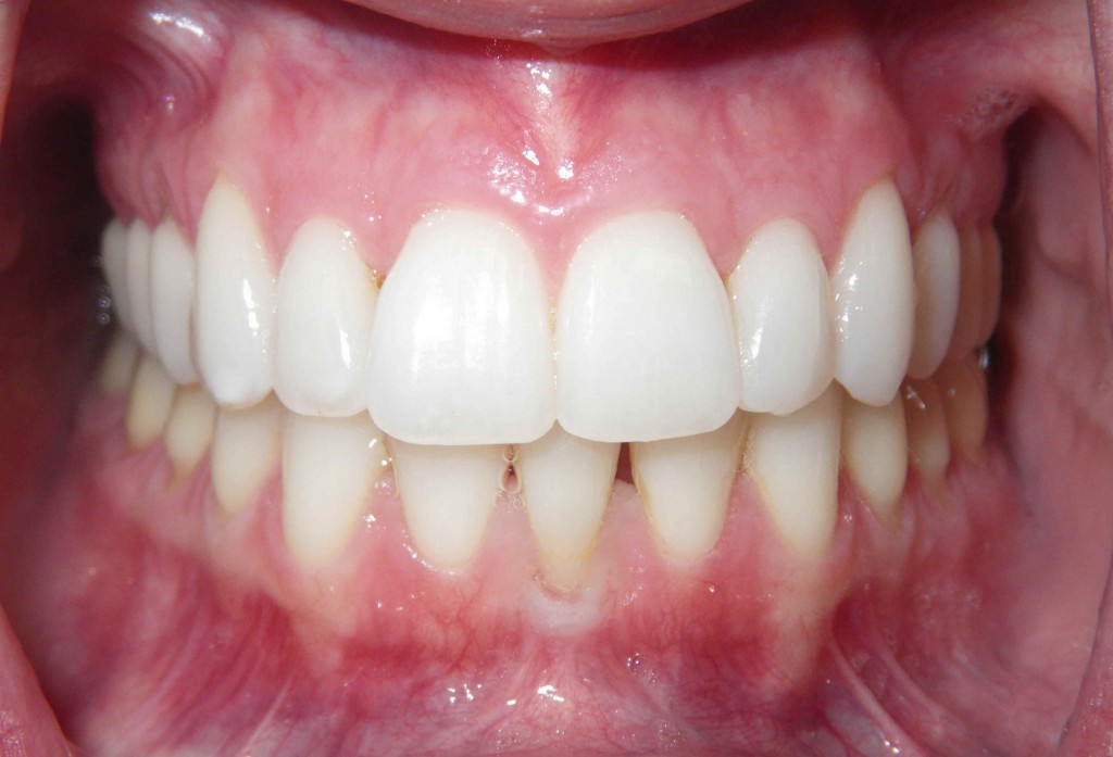 Frenectomy Kelowna BC